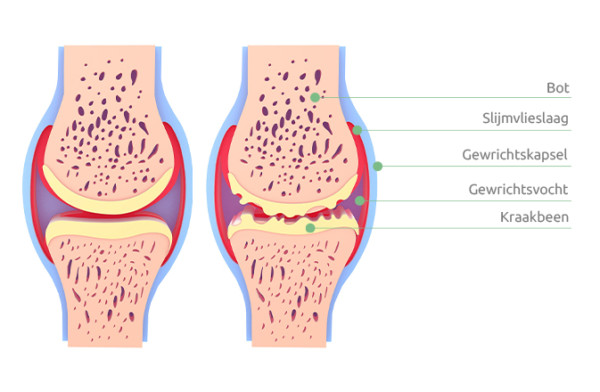 Wat is artrose? - Oorzaken en Symptomen - Otolift